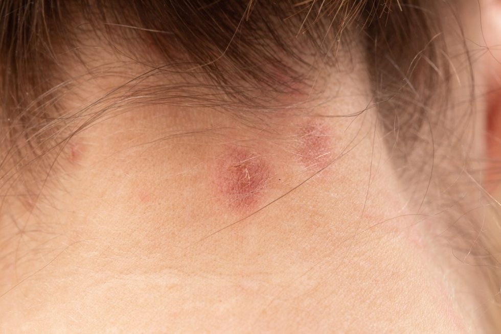 ¿Cómo aliviar los síntomas de la psoriasis en el cuero cabelludo ...