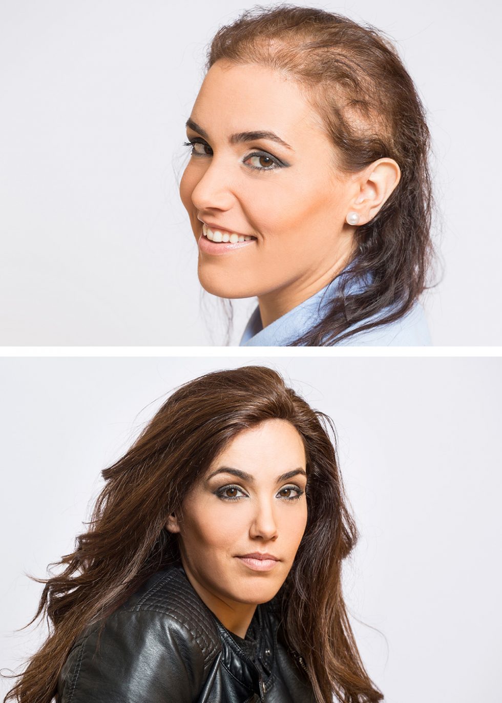 Prótesis capilares - Lo que necesitas saber