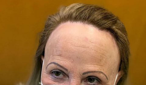 Alopecia difusa, comprender y tratar la pérdida de cabello generalizada ...